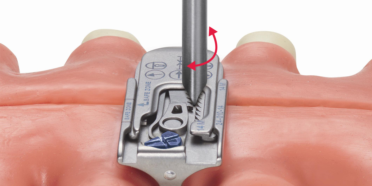 KLS Martin | Sternal Talon