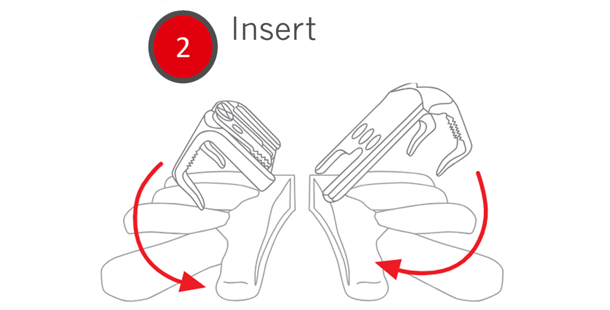 KLS Martin | Sternal Talon