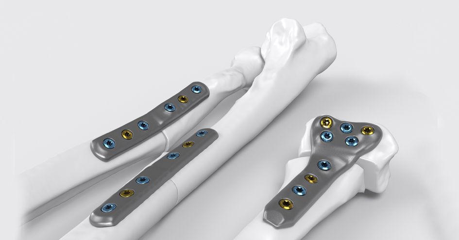 KLS Martin | IPS Implants® Forearm Reconstruction