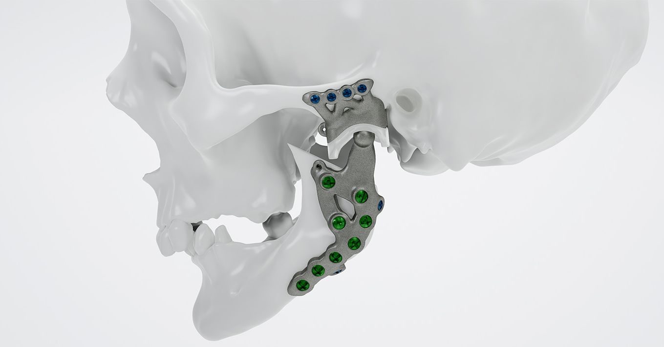 KLS Martin | IPS Implants® TMJ Prosthesis