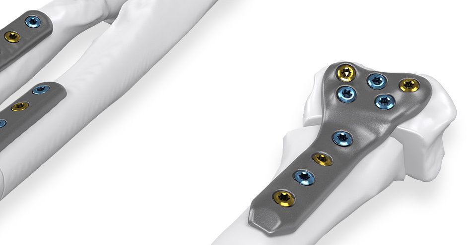 KLS Martin | IPS Implants® para las extremidades superiores