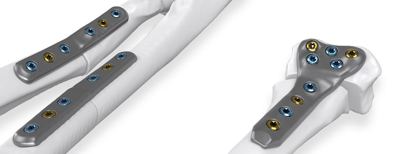 KLS Martin | IPS Implants® für die oberen Extremitäten