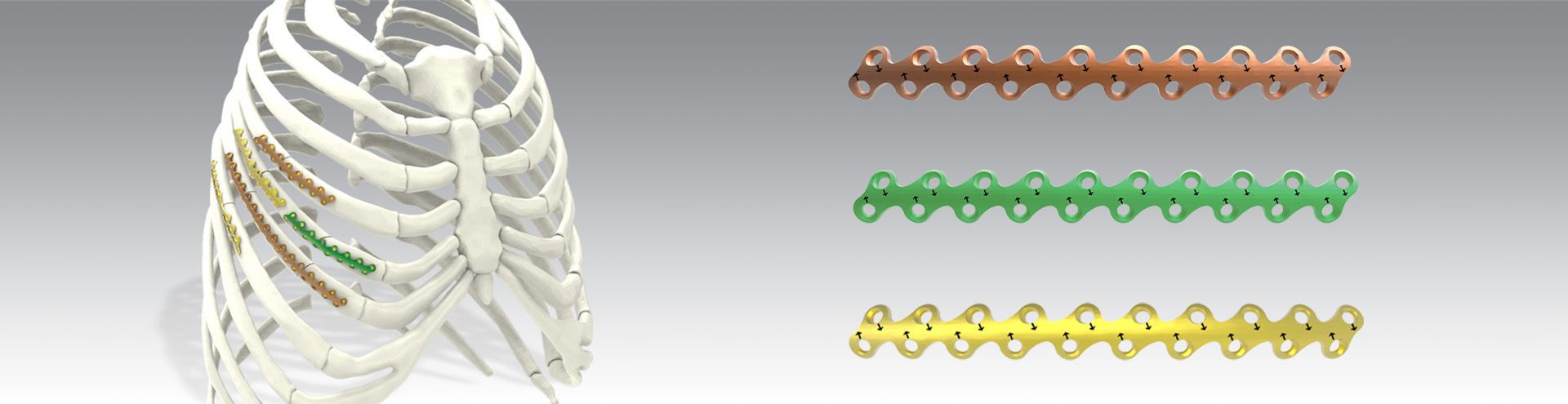 KLS Martin | Implants for The L1 Rib System