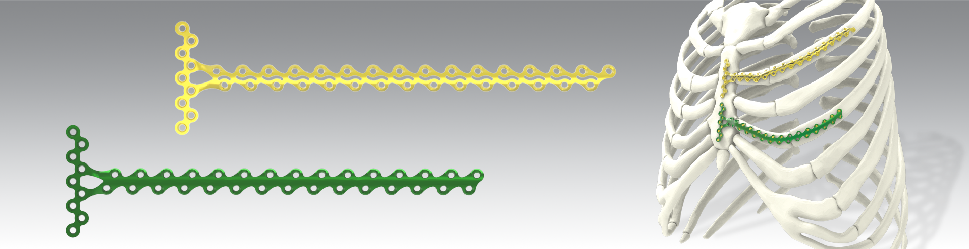KLS Martin | Implants for The L1 Rib System