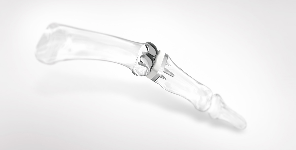 KLS Martin | Implant knowledge Hand