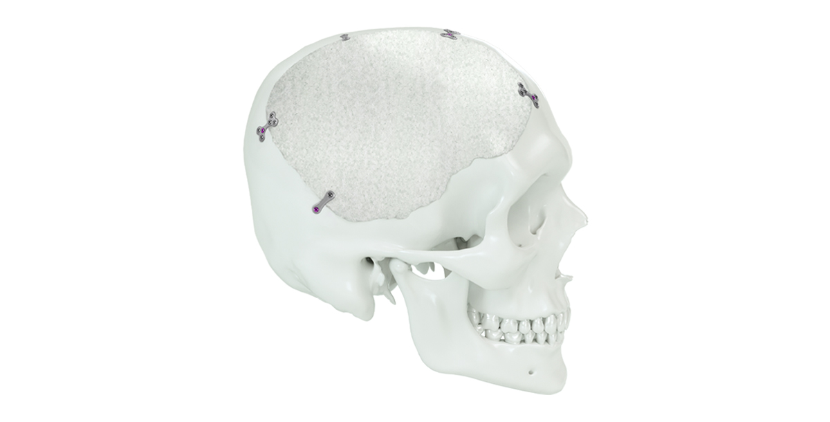 KLS Martin | IPS Implants®