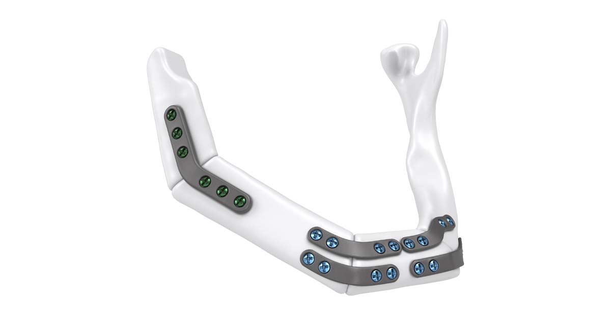 KLS Martin | IPS Implants® Mandible Reconstruction