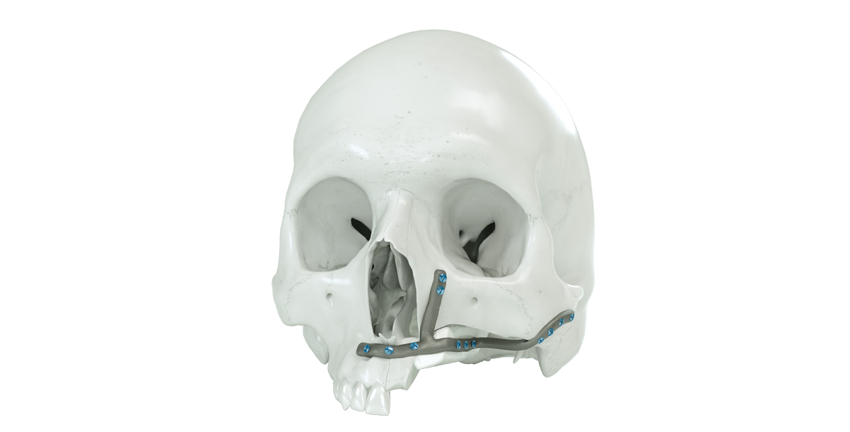 KLS Martin | IPS Implants® Mandible Reconstruction