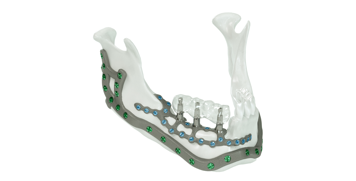 KLS Martin | IPS Implants® Mandible Reconstruction