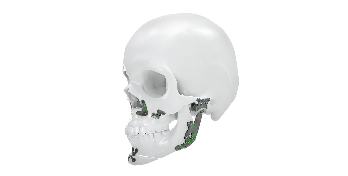 KLS Martin | IPS Implants® TMJ Prosthesis