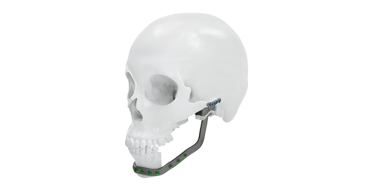 KLS Martin | IPS Implants® TMJ Prosthesis