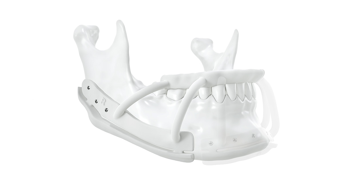 KLS Martin | IPS Implants® Transformation