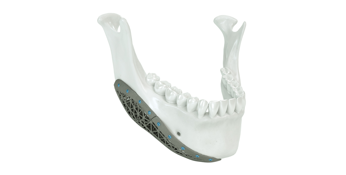 KLS Martin | IPS Implants®