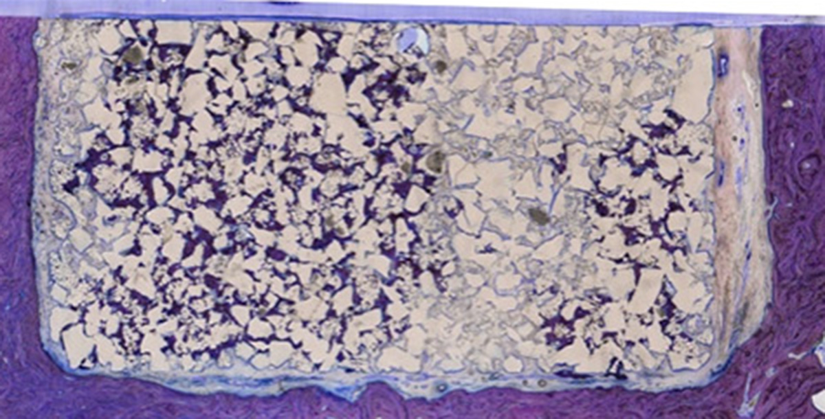 KLS Martin | IPS Implants®