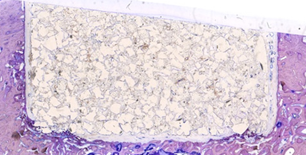 KLS Martin | IPS Implants®