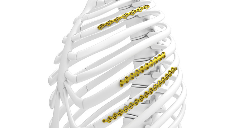 KLS Martin | Implant knowledge Hand