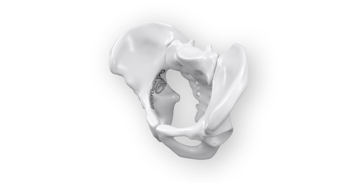 KLS Martin | Nexos® Pelvis