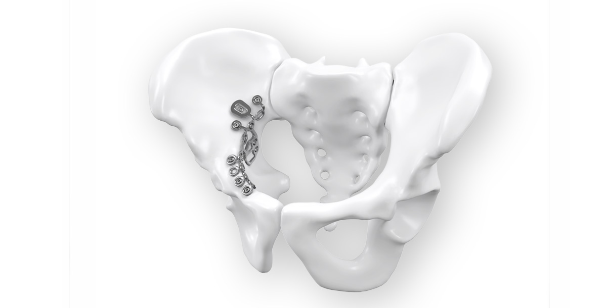 KLS Martin | Nexos® Pelvis