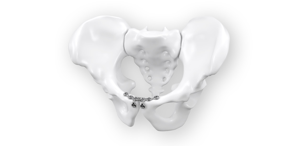 KLS Martin | Nexos® Pelvis