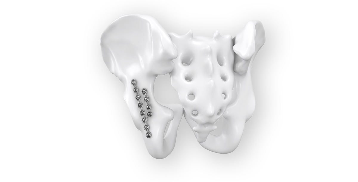 KLS Martin | Nexos® Pelvis