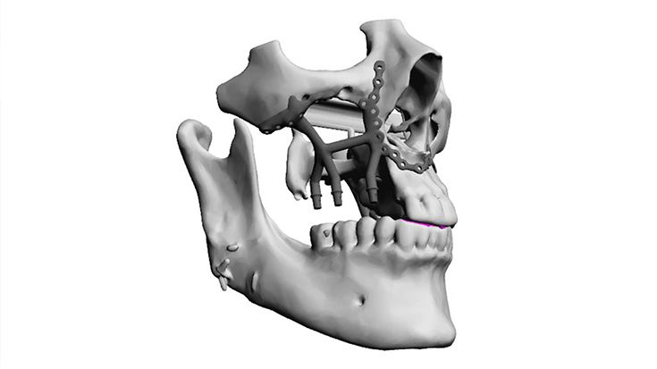 KLS Martin | IPS Implants Preprosthetic®