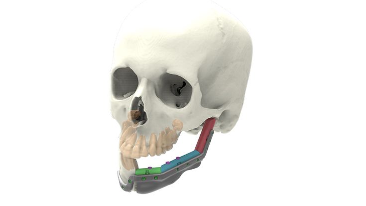 KLS Martin | IPS® Implants