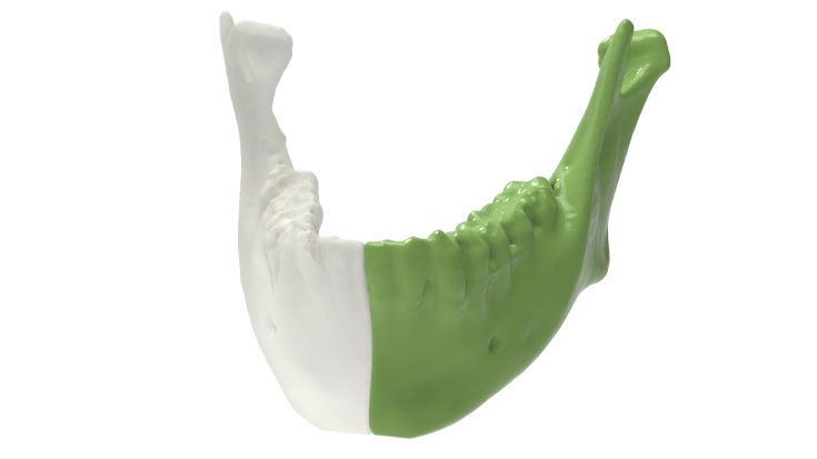 KLS Martin | IPS® Implants
