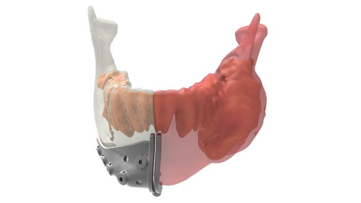 KLS Martin | IPS® Implants